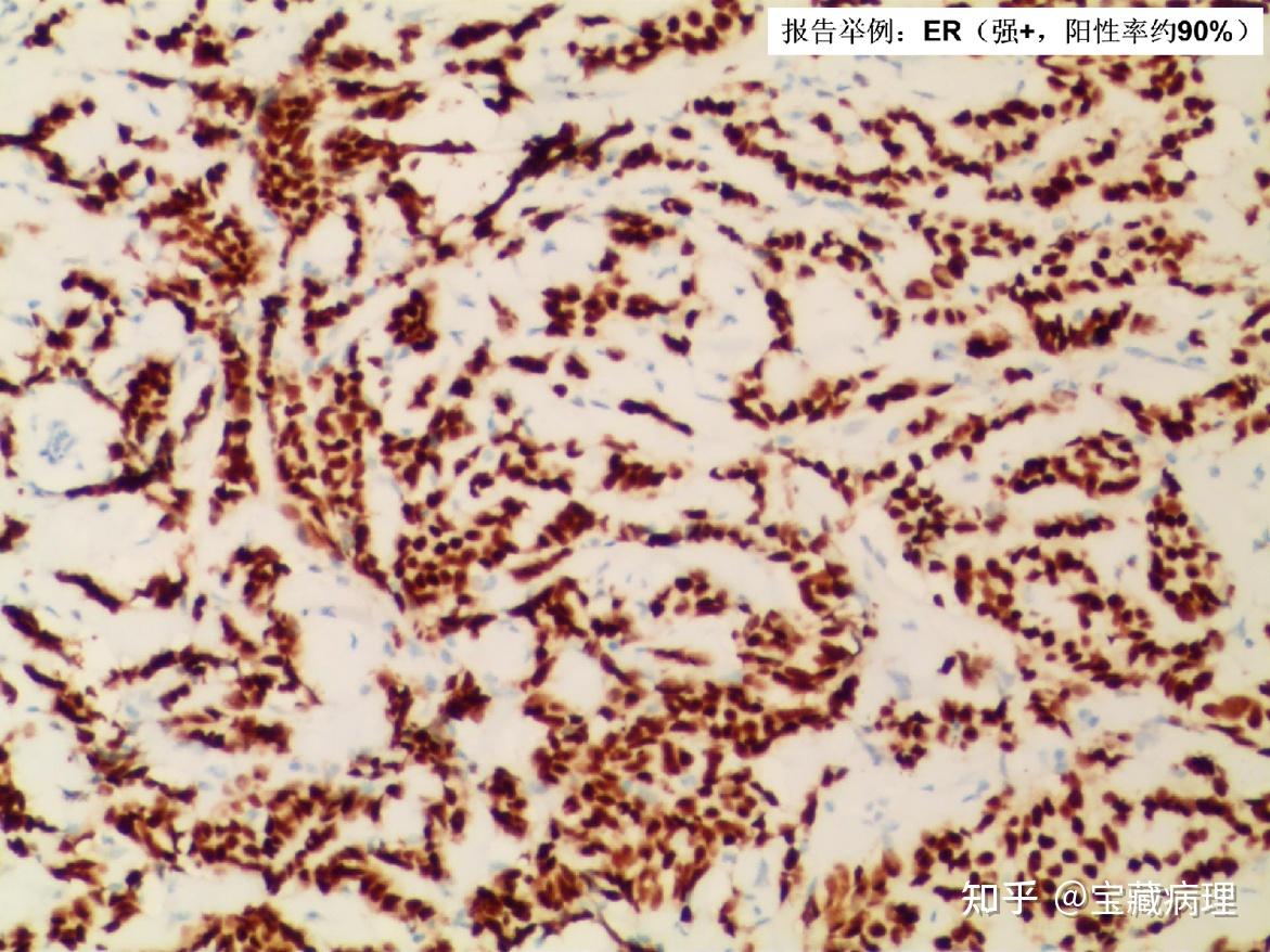 病理规培：一文掌握乳腺癌ER、PR免疫组化判读 - 知乎