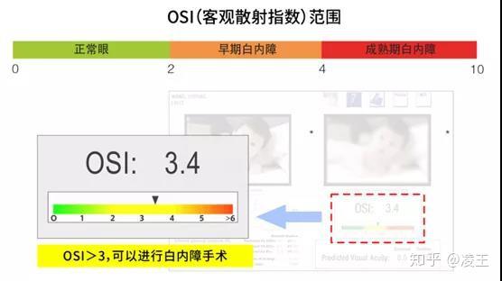 白内障的临床表现 - 知乎