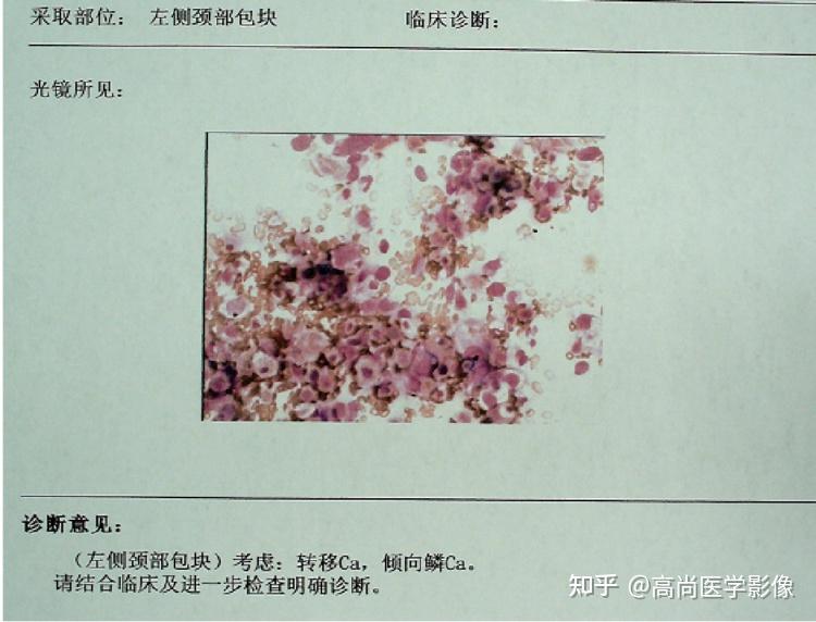扁桃体癌3例【PET/CT诊断病例】 - 知乎