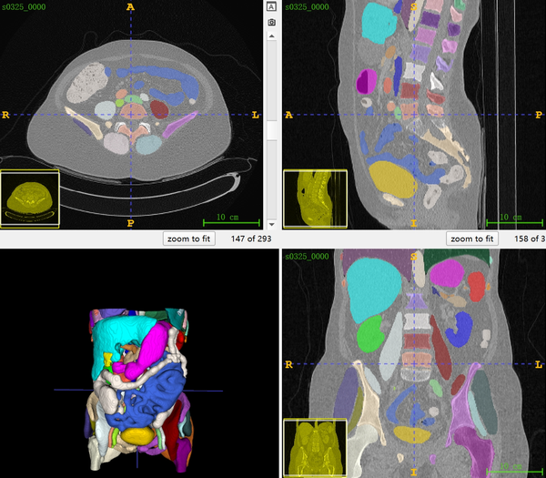 TotalSegmentator v2 数据集介绍 - 知乎