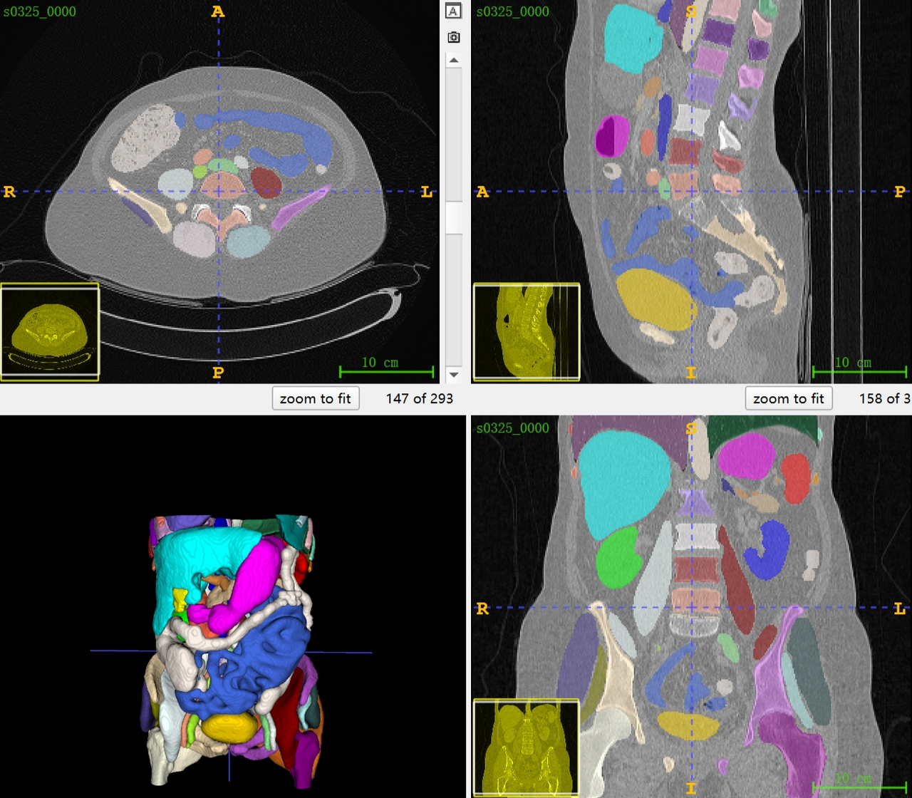 TotalSegmentator v2 数据集介绍 - 知乎
