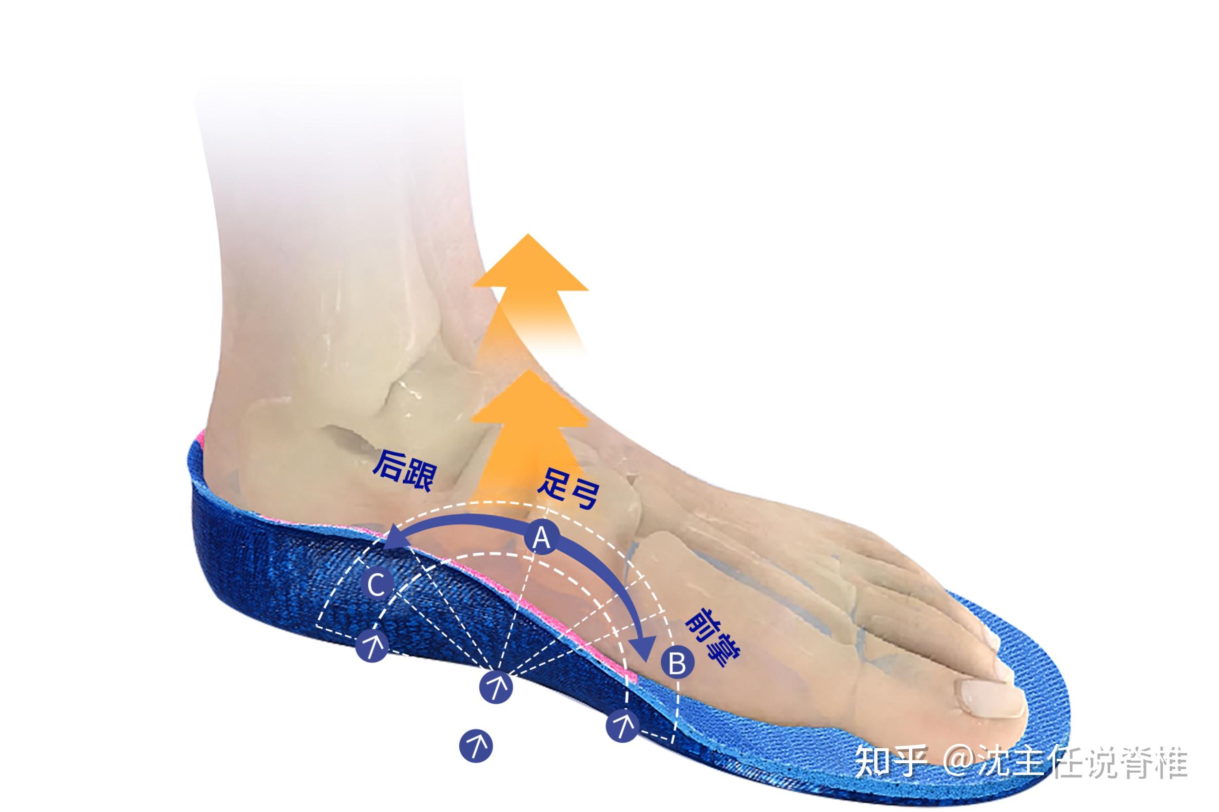 扁平足，为什么要定制矫形鞋垫？是不是智商税？告知您真相 - 知乎