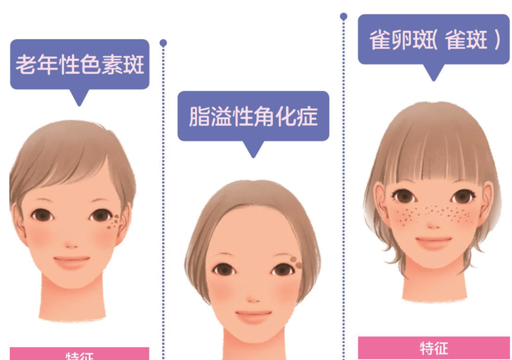 如何应对色斑，才能让肌肤变得白皙 知乎