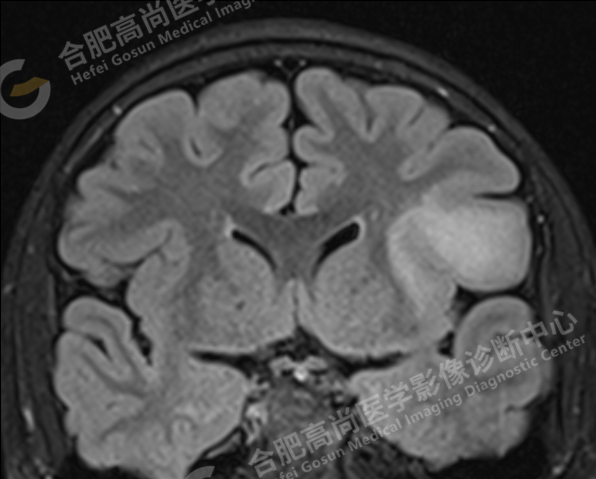 病例科普：头颅MR诊断局灶性皮层发育不良（FCD） - 知乎