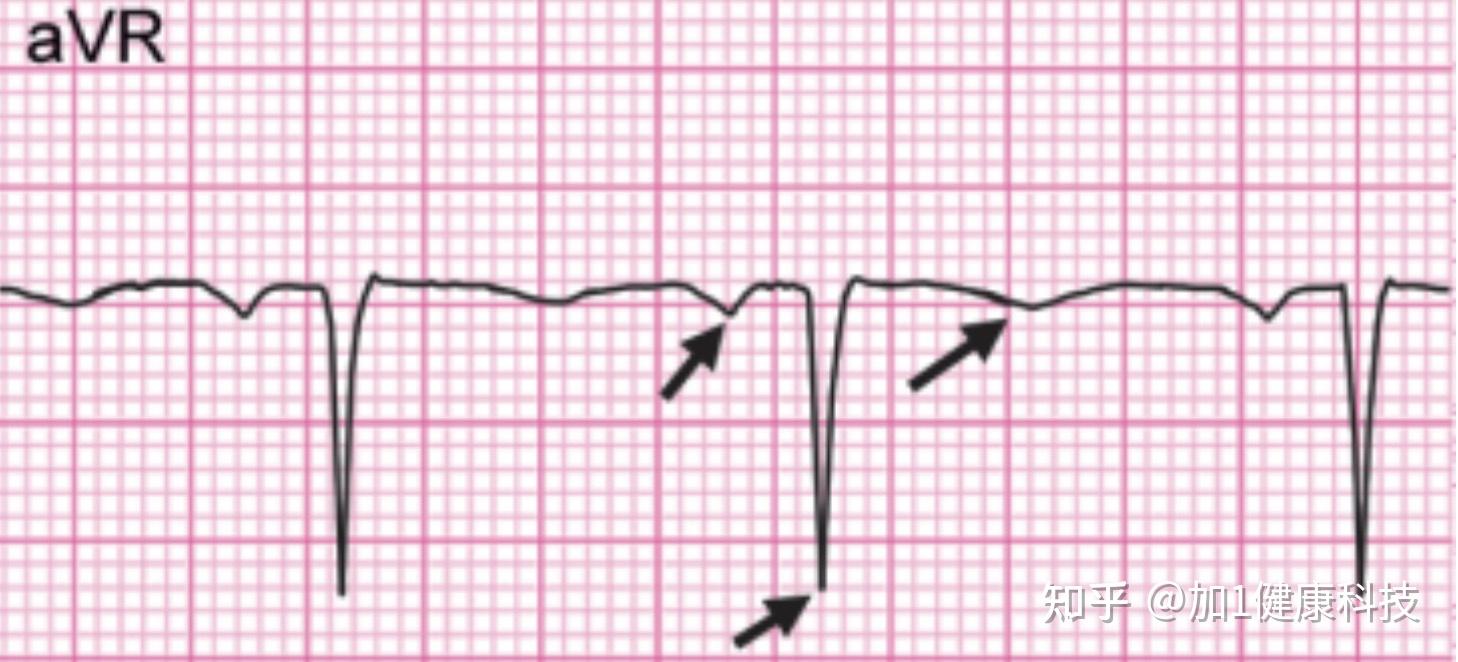5分钟读懂心电图-导联aVR、心率 、心搏节律【纯干货】 - 知乎
