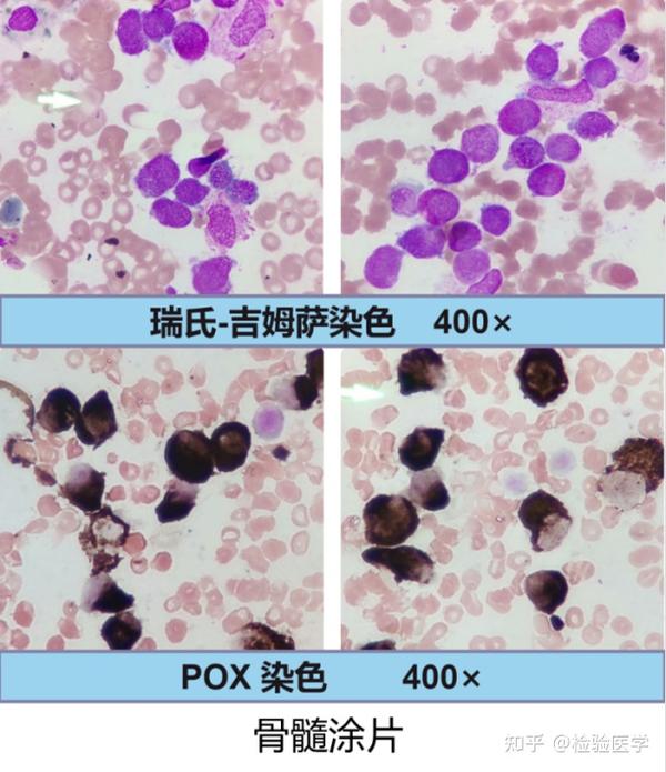 隐形的杀手-急性早幼粒细胞白血病1例 - 知乎