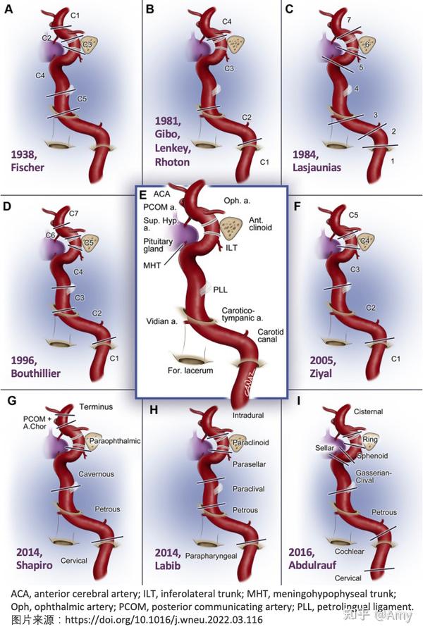 颈内动脉的8种分段系统 - 知乎