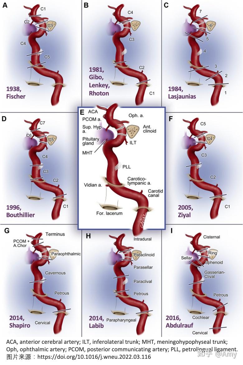 颈内动脉的8种分段系统 - 知乎