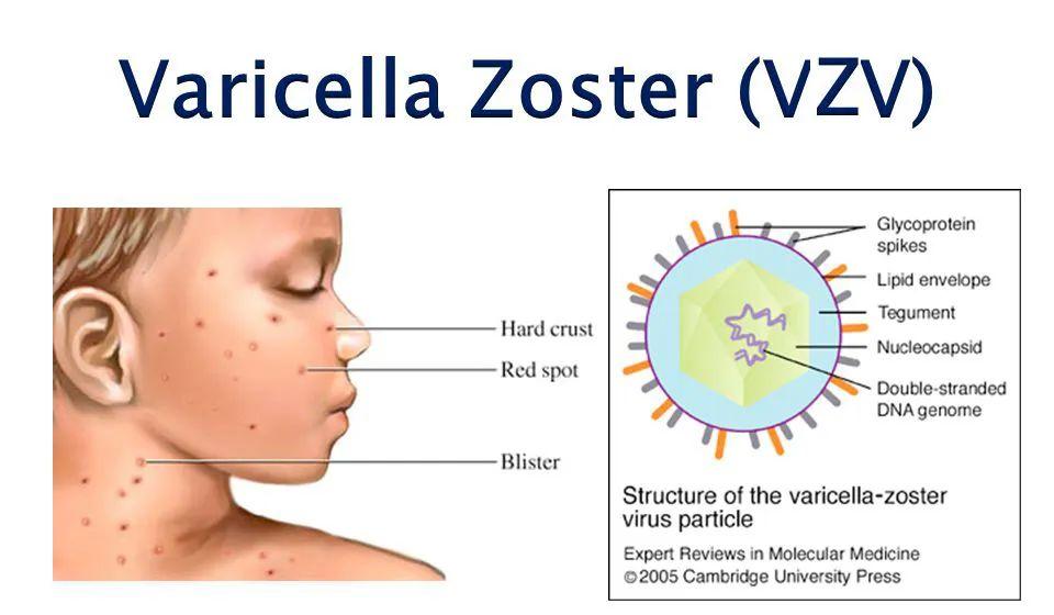 引发百亿市场争夺战的带状疱疹病毒（VZV）到底是何方神圣？ - 知乎