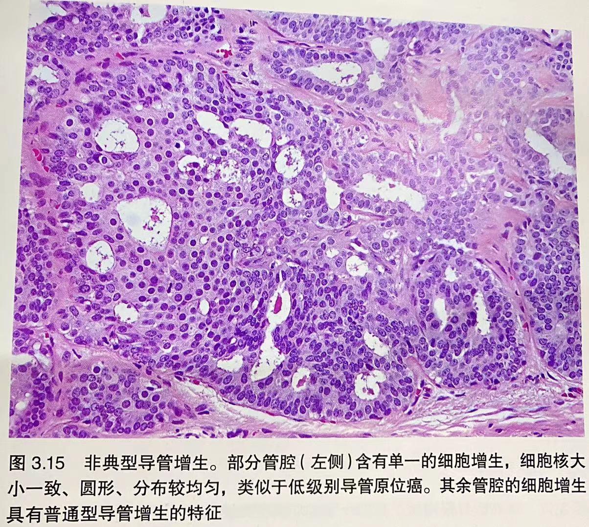 乳腺导管增生性疾病的病理诊断 - 知乎