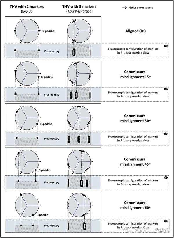 连合对齐（Commissural Alignment）：原理、定义、技术和结果（中） - 知乎