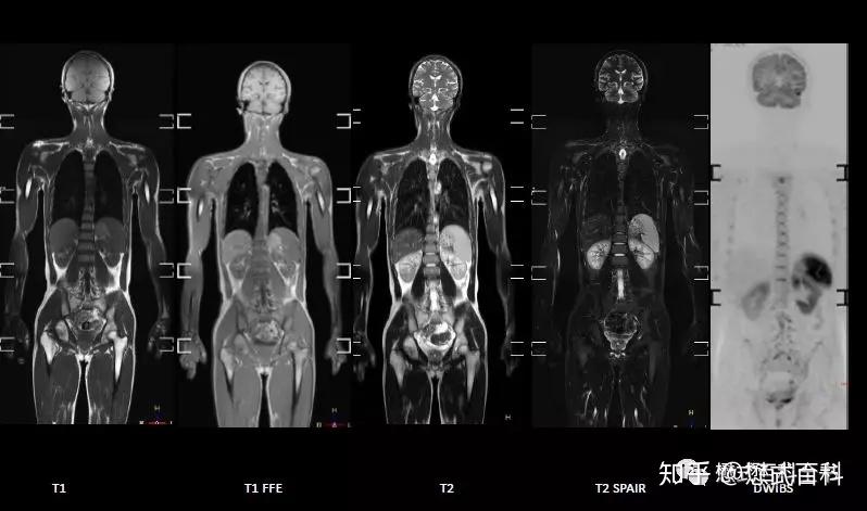 磁共振全身成像技术（一） - 知乎