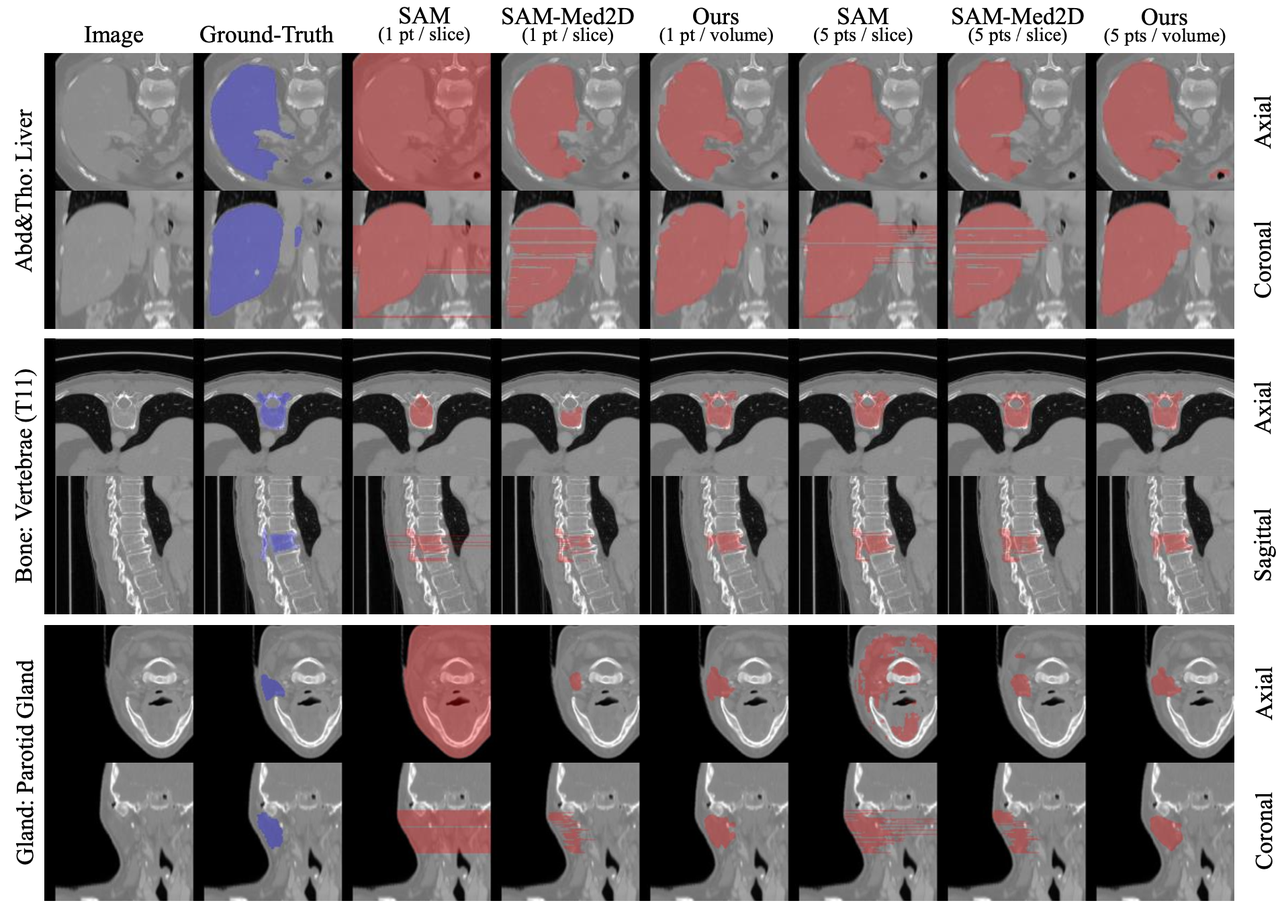 SAM-Med3D：三维医学图像上的通用分割模型，医疗版三维 SAM 开源了！ - 知乎