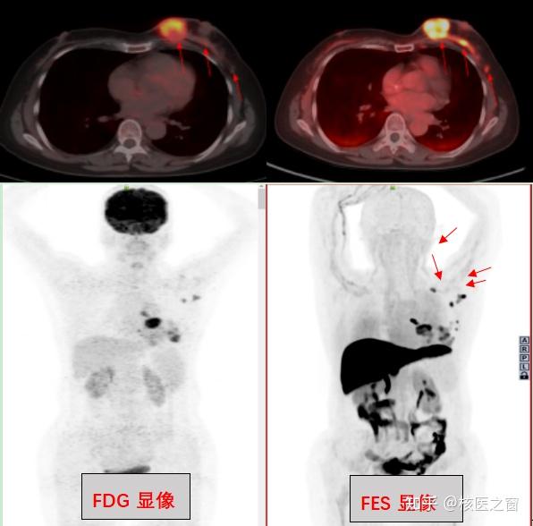18F-FES PET/CT靶向核素显像助力ER阳性乳腺癌精准诊断 - 知乎