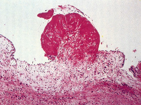 循环病理学：风湿病、风湿性心脏病、风湿性瓣膜病 - 知乎