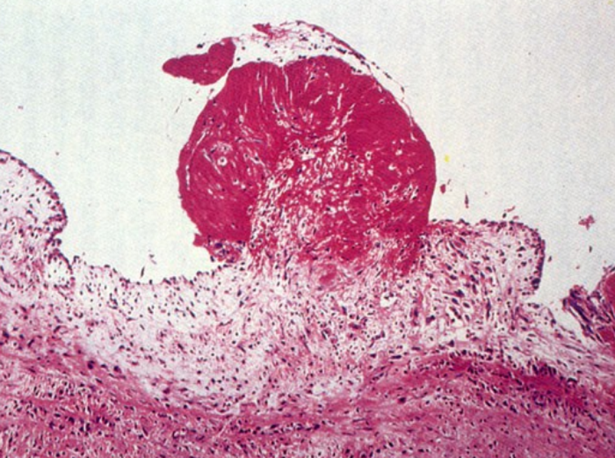 循环病理学：风湿病、风湿性心脏病、风湿性瓣膜病 - 知乎