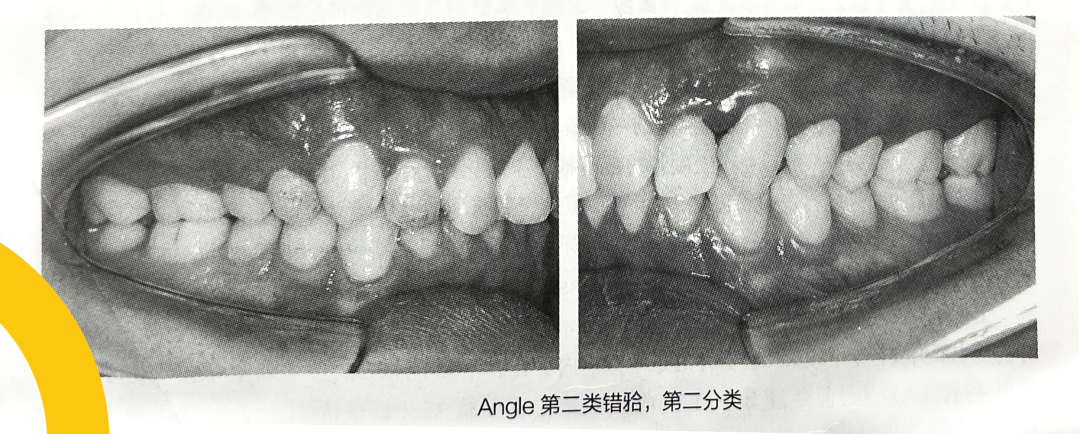 病例诊断｜错𬌗畸形的分类、检查与诊断 - 知乎