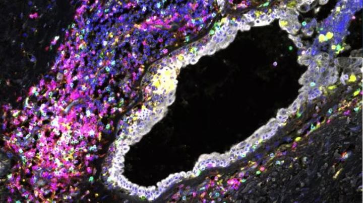 Nat Genetics | 新发现！免疫疗法有望预防乳腺癌病发，携带BRCA突变的乳腺组织免疫细胞显著耗竭 - 知乎