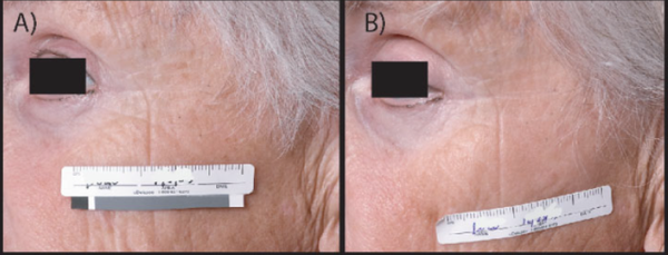 Rox Anderson：从激光医学之父到最成功的医生创业者 - 知乎