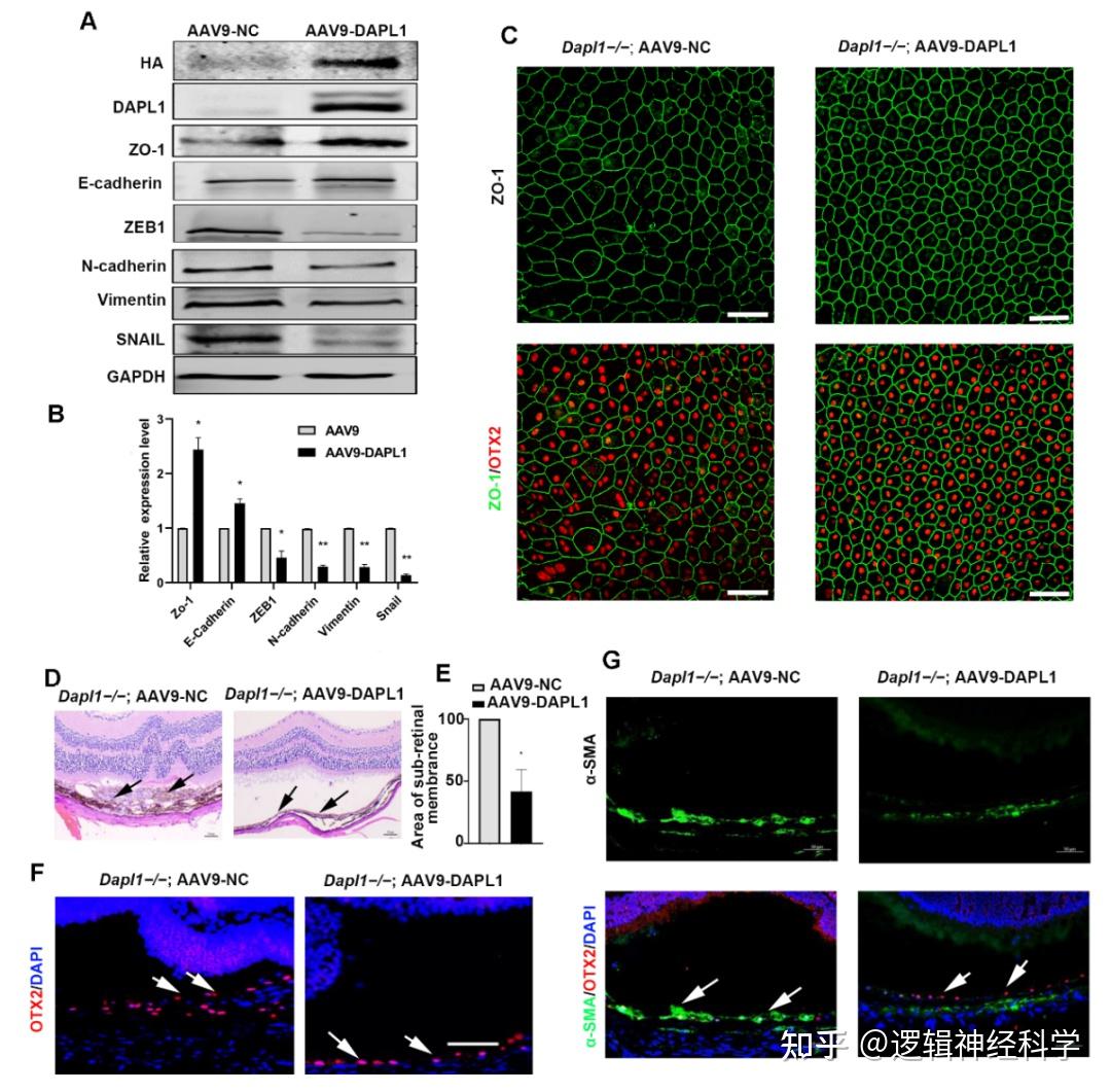 Cell Death Dis︱温州医科大学麻晓银/侯陵团队揭示：DAPL1调控RPE细胞上皮-间质转化抑制增殖性玻璃体视网膜病变的进展 - 知乎