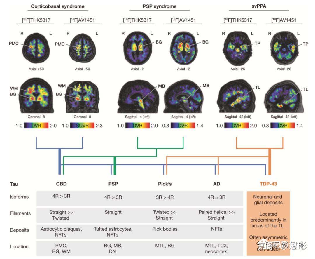 Tau PET成像在神经退行性Tau病中的应用—仍然是一个挑战 - 知乎