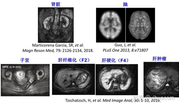 Cutting Edge-磁共振弹性成像（MRE）简介 - 知乎
