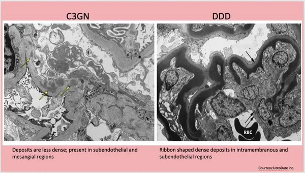 罕见肾病新药诺华LNP023胶囊纳入“突破性疗法” - 知乎