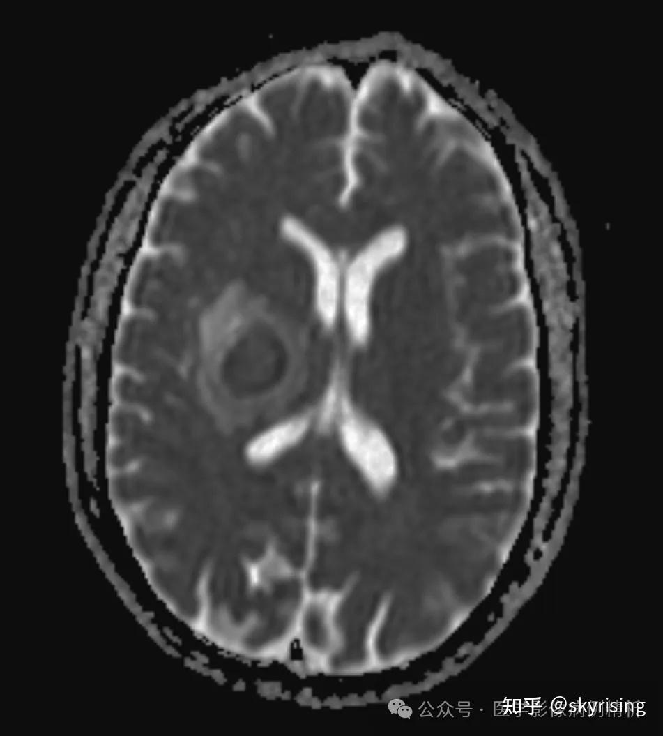 【MRS实战最终版】五例脑实质肿瘤或肿瘤性病变或良性病变MRS影像鉴别诊断并中英文报告模板范例 - 知乎