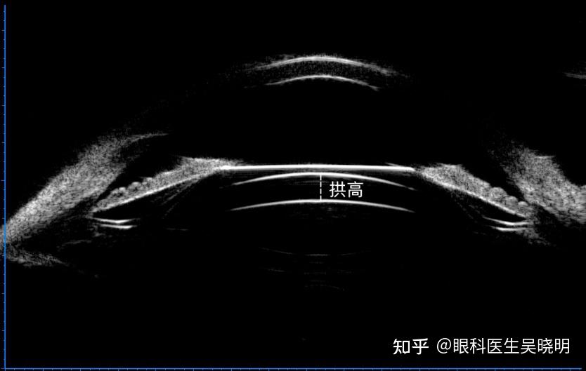 ICL晶体植入术前检查之UBM，为什么术前要做UBM检查？ - 知乎
