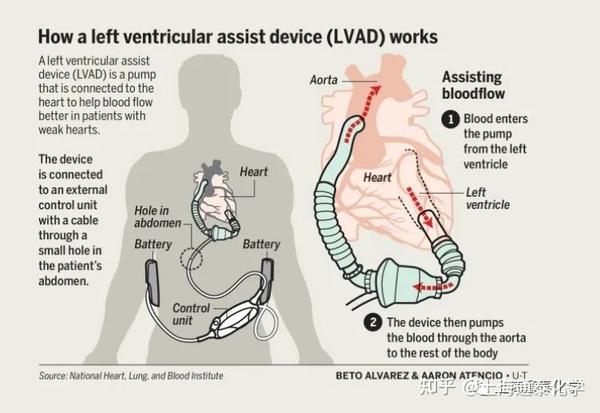 左心辅助装置（LVAD） - 知乎