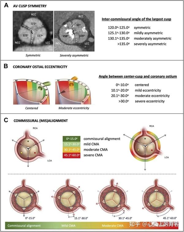 连合对齐（Commissural Alignment）：原理、定义、技术和结果（上） - 知乎