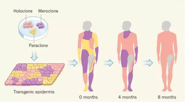 Nature重磅！再生全身皮肤，干细胞让7岁生命转危为安！ - 知乎