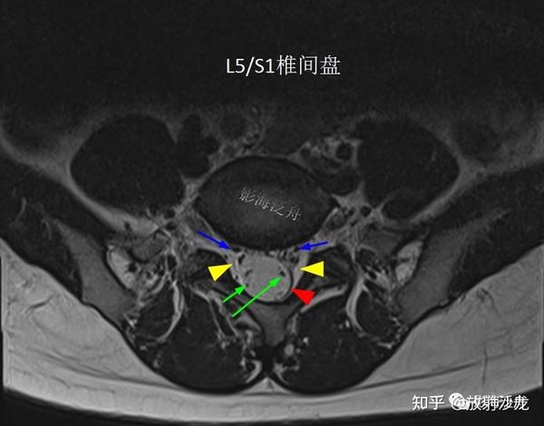 这个病，腰椎MR经常会漏诊！ - 知乎