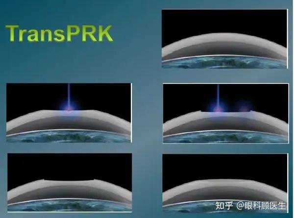 各类角膜表层激光手术汇总 - 知乎