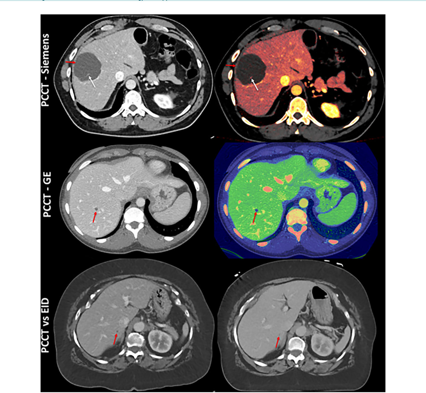 CT技术革命？一文读懂光子计数CT（PCCT）的前沿进展与临床潜力 - 知乎