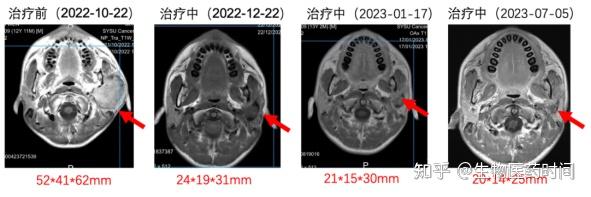 新一代NTRK抑制剂ICP-723治疗实体瘤临床研究病案分享 - 知乎