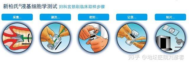 TCT报告单怎么看？ - 知乎