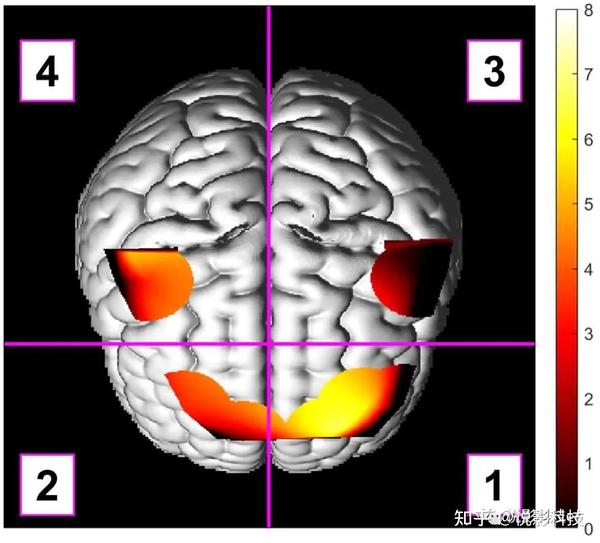 老年人Stroop任务期间颈动脉粥样硬化与脑激活模式的联系：fNIRS研究 - 知乎