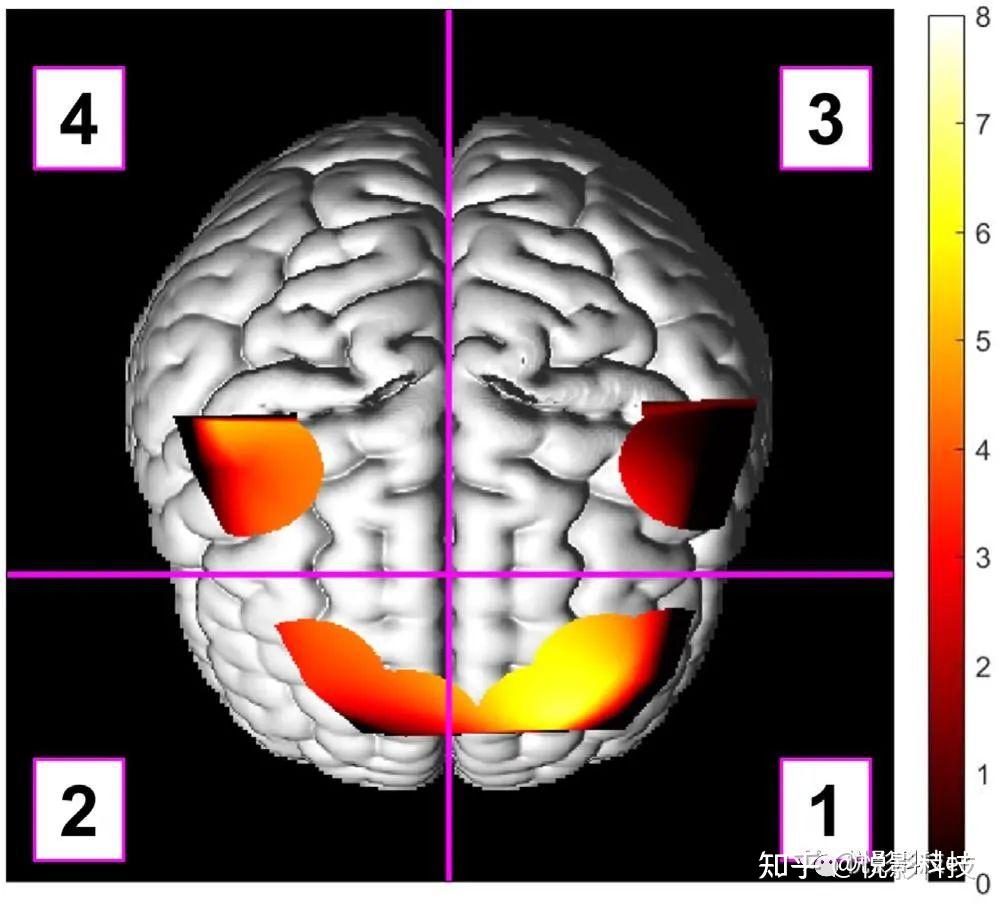 老年人Stroop任务期间颈动脉粥样硬化与脑激活模式的联系：fNIRS研究 - 知乎