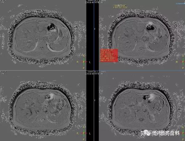什么叫做磁化传递MTC？ - 知乎