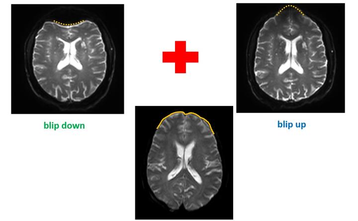 消除EPI几何形变技术——EPIC - 知乎