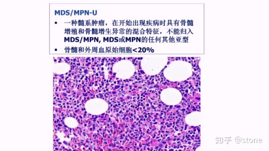 MDS/MPN（骨髓增生异常综合征/骨髓增殖性肿瘤） - 知乎
