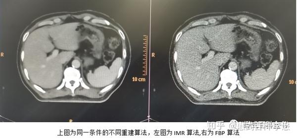 什么是4D CT？4D CT会带来很高的辐射剂量吗？ - 知乎