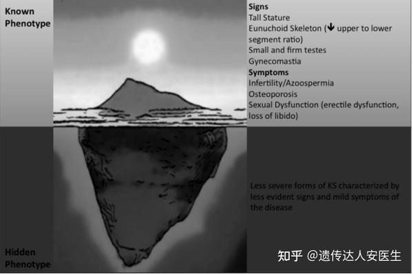 Klinefelter综合征（47, XXY）|已识别的表型仅冰山一角，大部分患者从未得到诊断 - 知乎