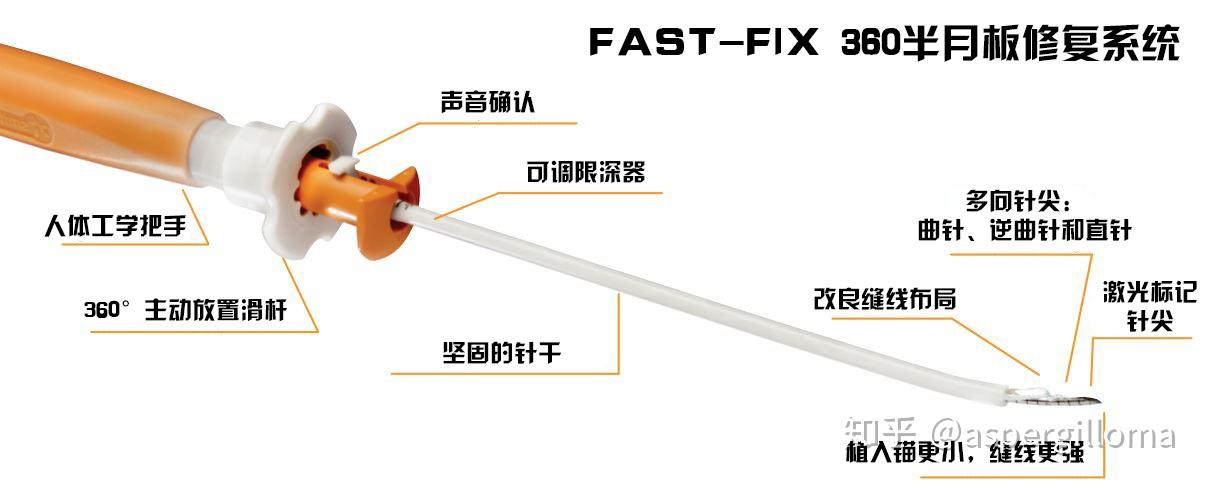 半月板缝合全内(All-inside)技术解读 - 知乎