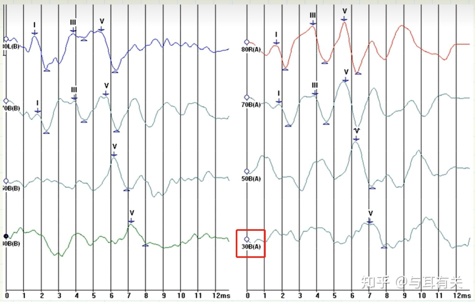 听性脑干反应(ABR) 操作方法、结果解读及临床应用 - 知乎