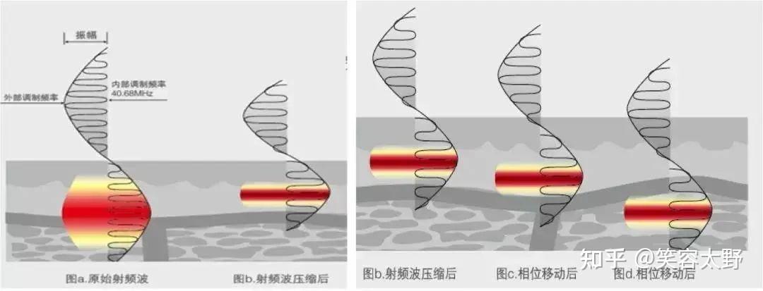 Accentpro深蓝射频与热拉提有何不同之处？ - 知乎