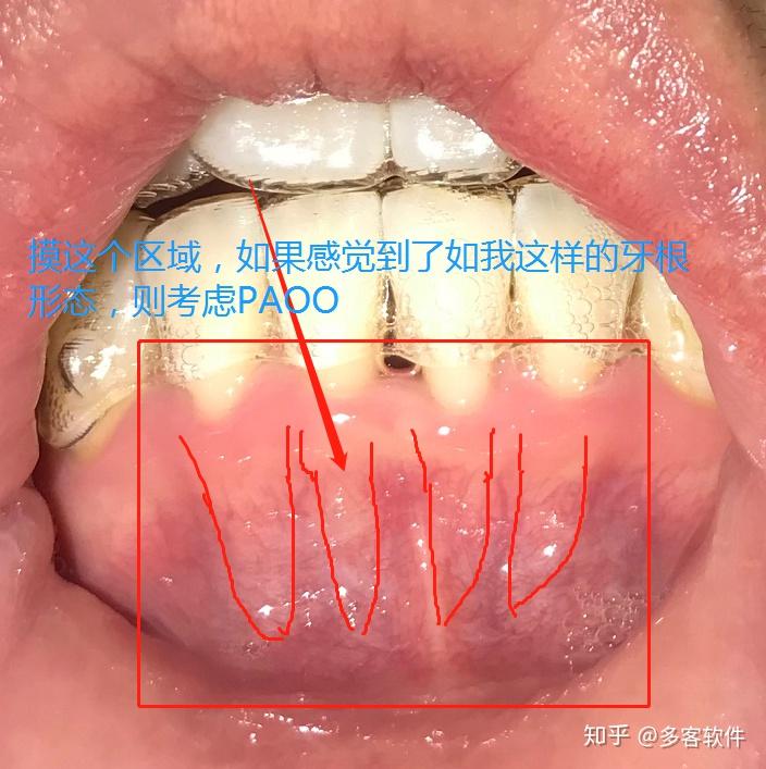 正畸+paoo手术？ - 知乎