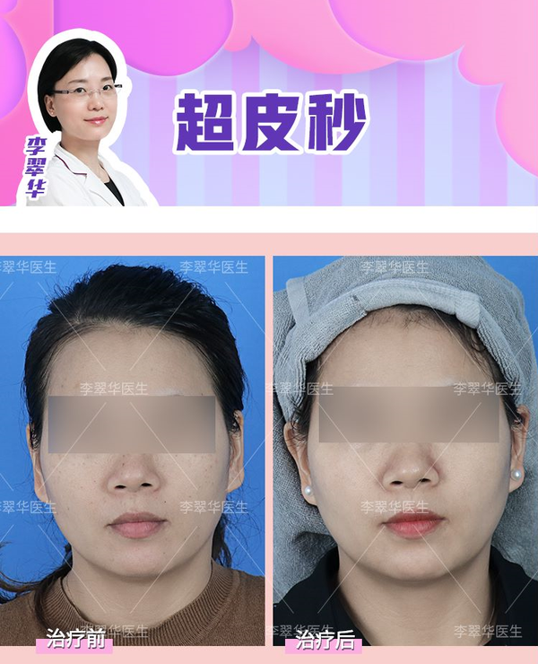 M22光子嫩肤和超皮秒的区别在哪?最全对比干货! 知乎