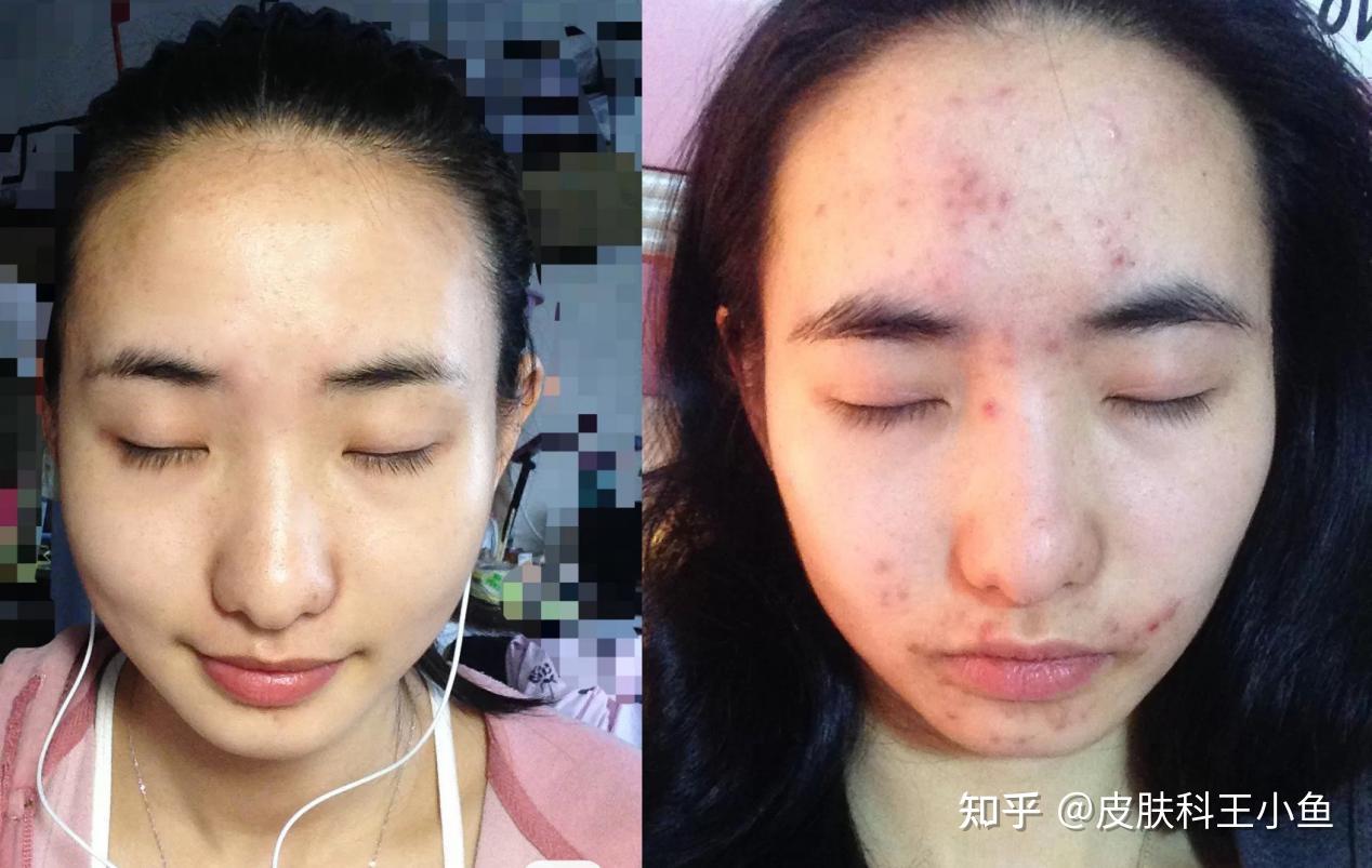 痘痘消了又长,如何28天快速祛除脸上的痘痘?【皮肤科医生】教你最详细祛痘步骤攻略,油痘肌照这篇学就够了~ 知乎